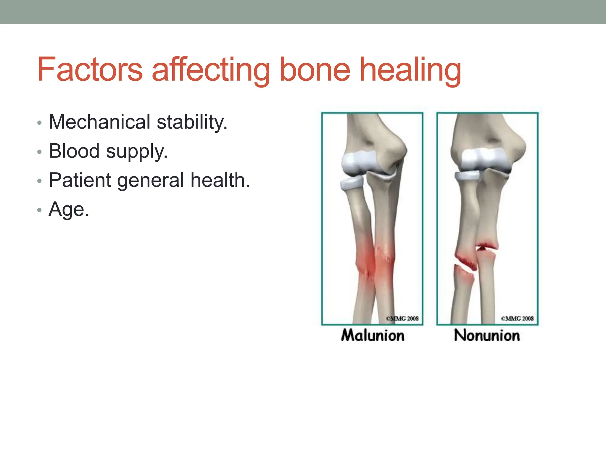 fracture healing in orthopedics in a nutshell.pdf