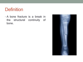 fracture healing in orthopedics in a nutshell.pdf