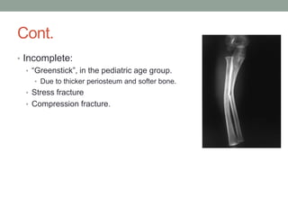 fracture healing in orthopedics in a nutshell.pdf