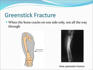 FRACTURE.ptDrJallohamaduscsmakambomakeni | PPT