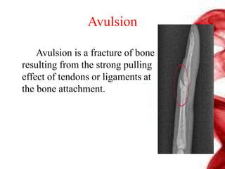 fracture management and reduction and its management | PPTX