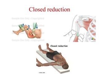 fracture management and reduction and its management | PPTX