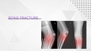 Fracture.pptx with its type and causes and pathophysiology and clinical ...