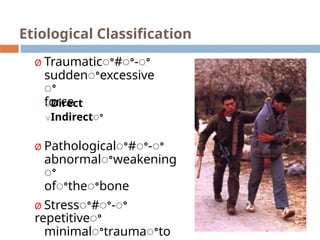Fracture.ppt full and clear power point for fracture | PPT