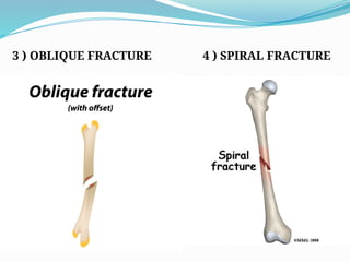 FRACTURE and types of fracture problems .pptx