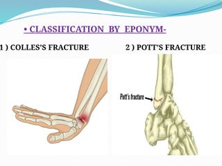 FRACTURE and types of fracture problems .pptx