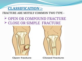 FRACTURE and types of fracture problems .pptx
