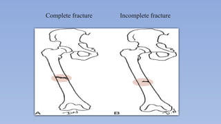 FRACTURE.pptx FOR NURSING STUDENTS CREATED BY KIRAN KARETHA | PPTX