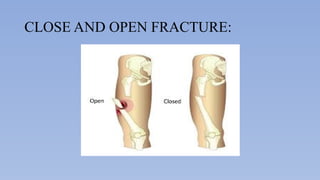 FRACTURE.pptx FOR NURSING STUDENTS CREATED BY KIRAN KARETHA | PPT
