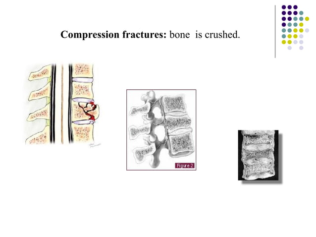 FRACTURE CLASSIFICATION AND MANAGEMENT.. | PPT
