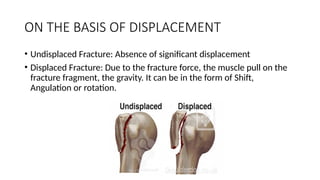 THE INTRODUCTION AND CLASSIFICATION OF THE FRACTURE.pptx