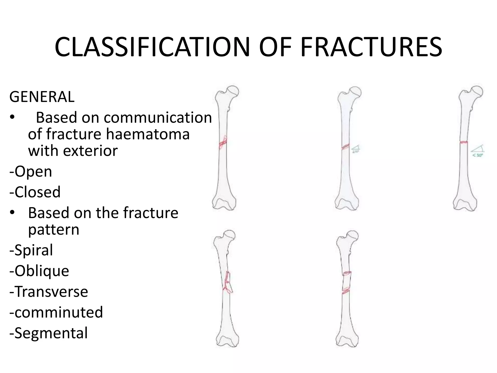 FRACTURE- Aetiology, Classification and Complications.pptx