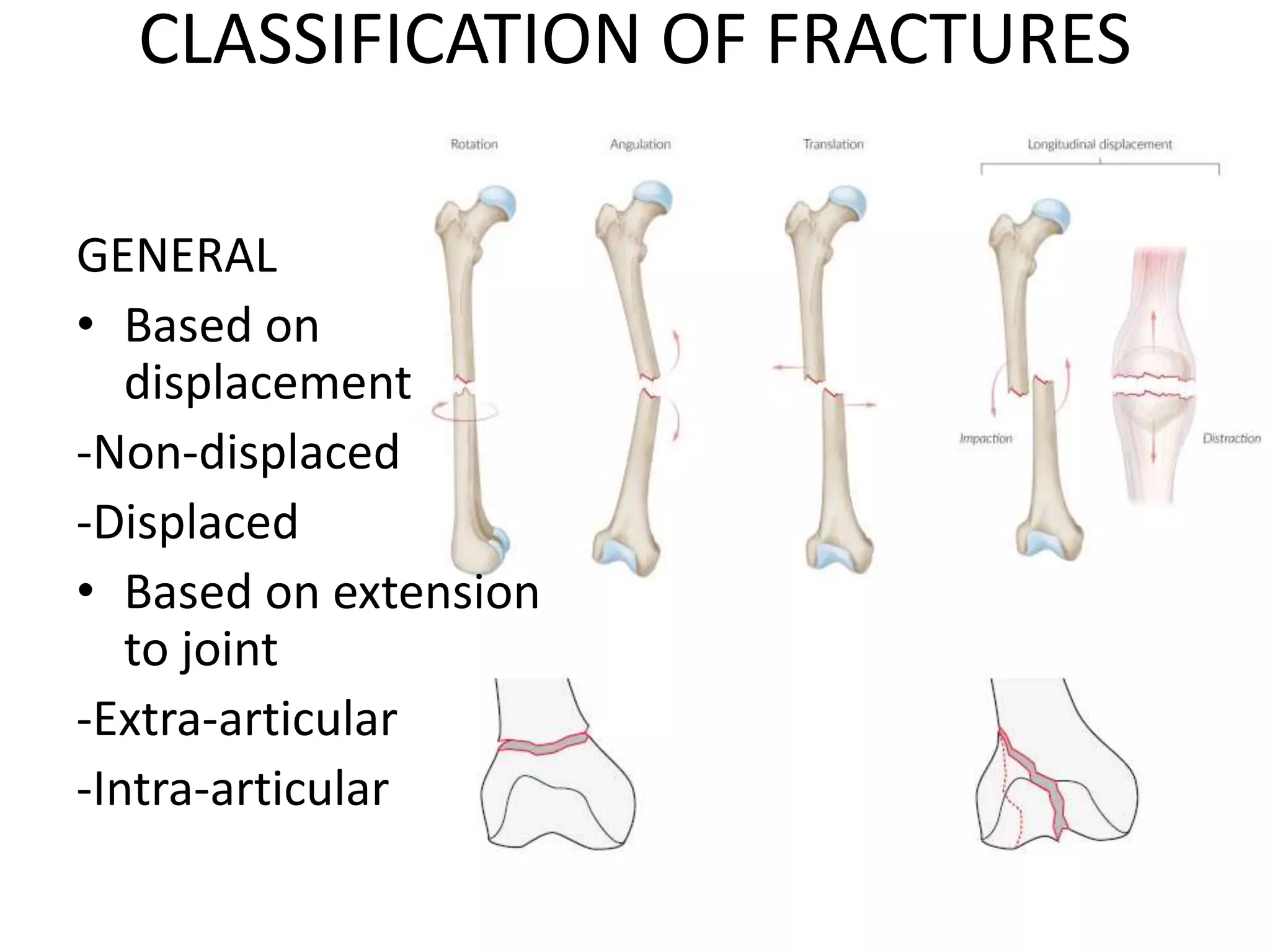 FRACTURE- Aetiology, Classification and Complications.pptx