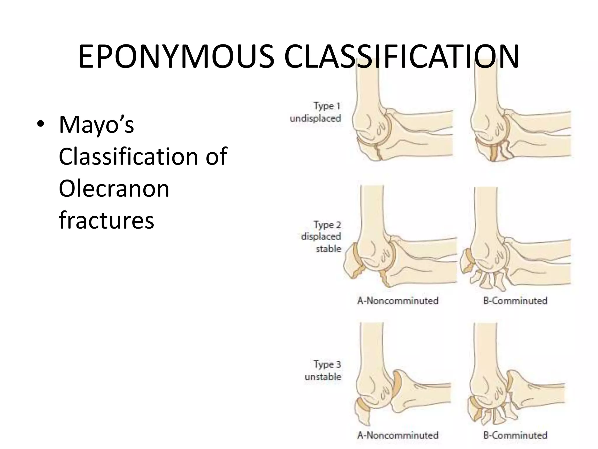 FRACTURE- Aetiology, Classification and Complications.pptx