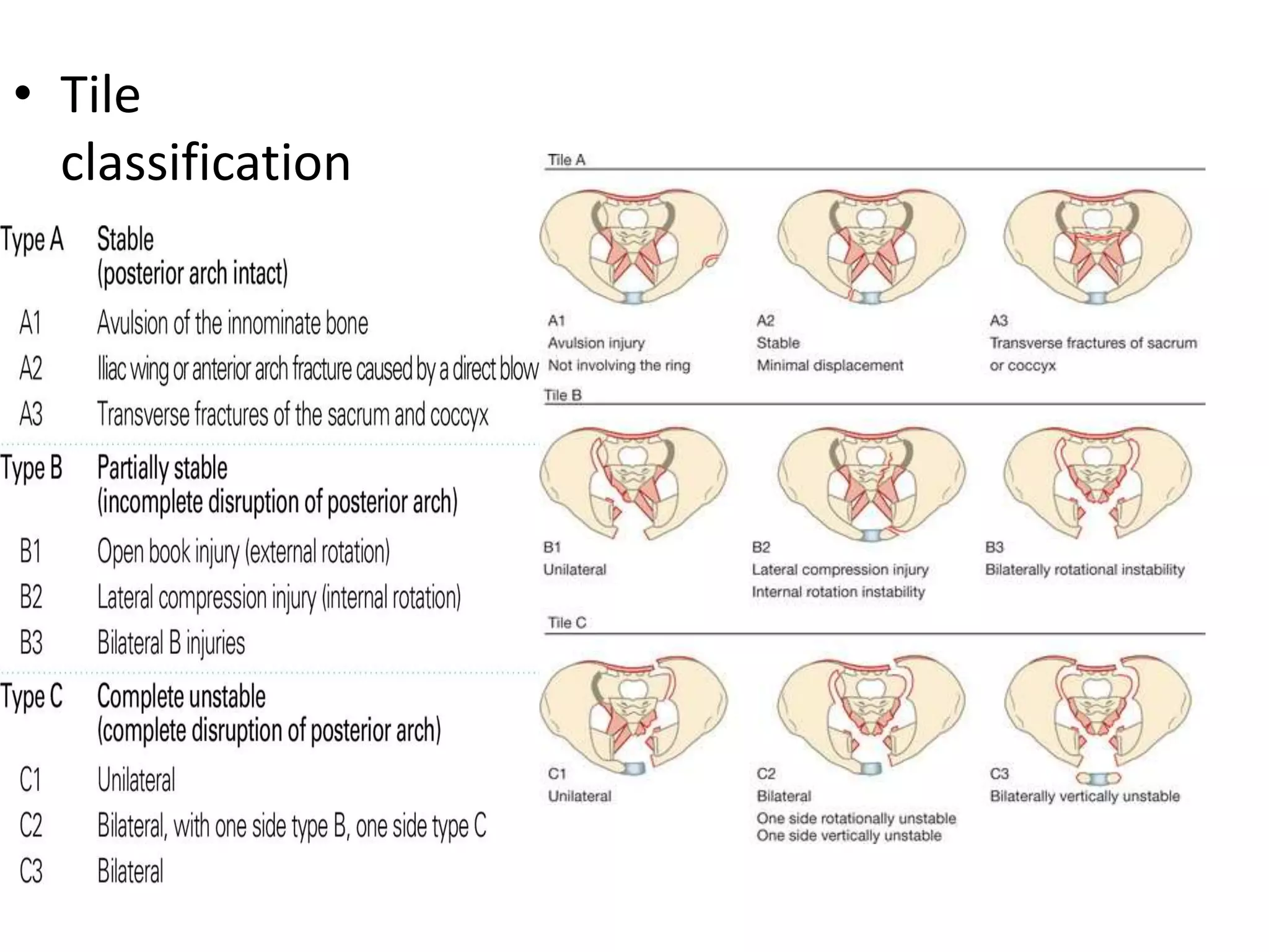 FRACTURE- Aetiology, Classification and Complications.pptx