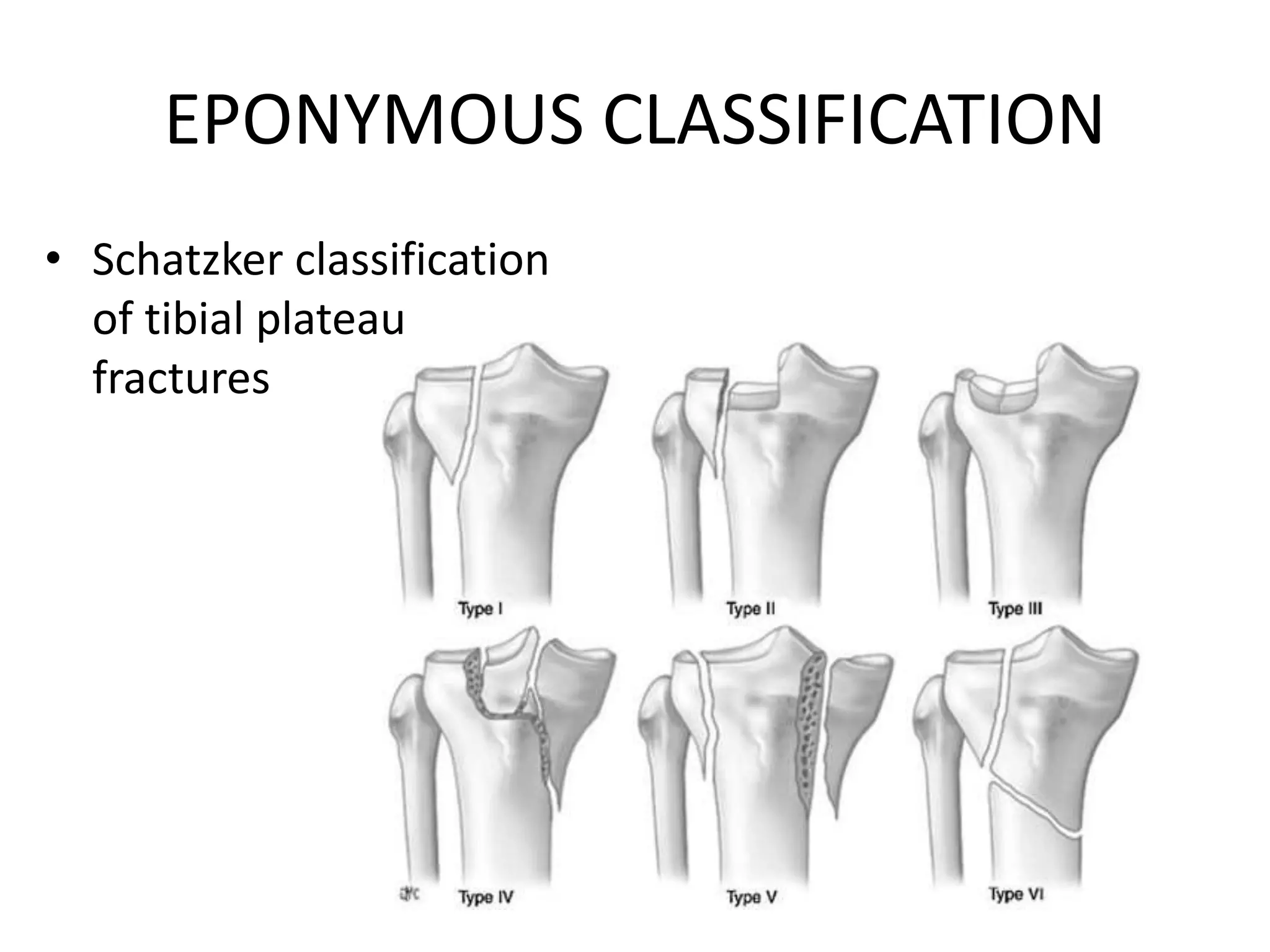 FRACTURE- Aetiology, Classification and Complications.pptx