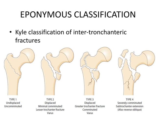 FRACTURE- Aetiology, Classification and Complications.pptx