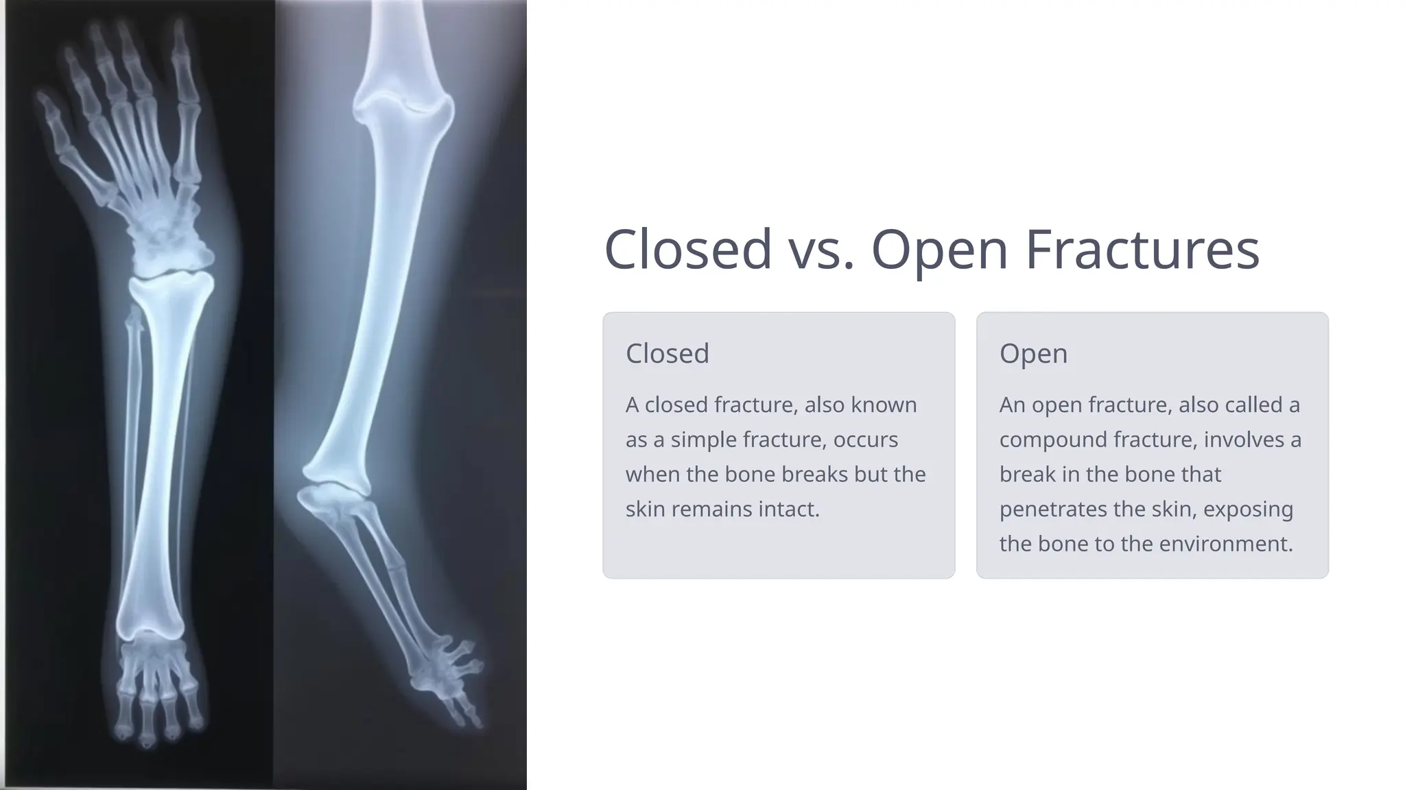 Fracture-Classification and types and differentiation | PPTX