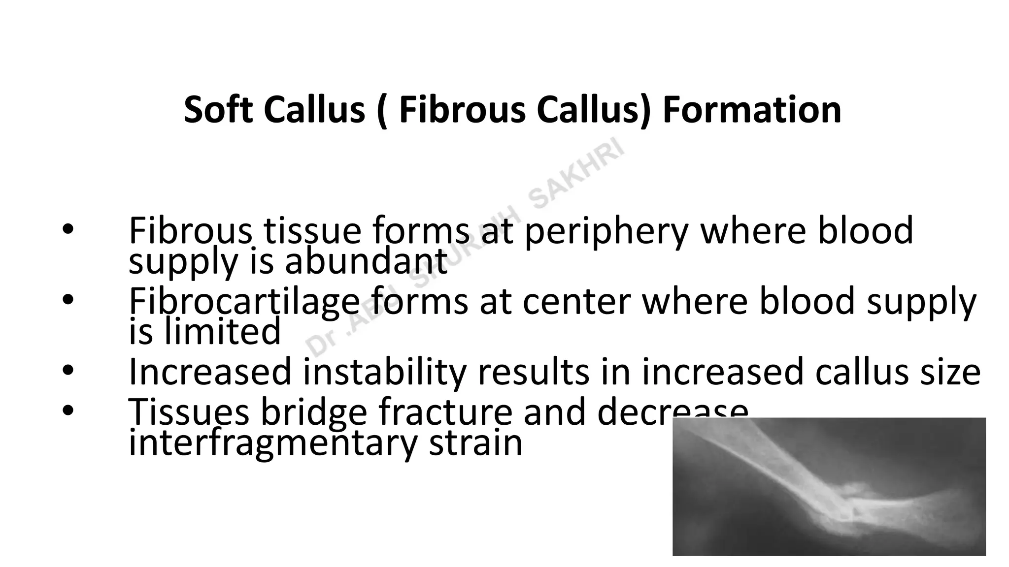Fracture Healing | PPT
