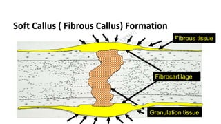 Fracture Healing | PPT