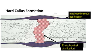 Fracture Healing | PPT