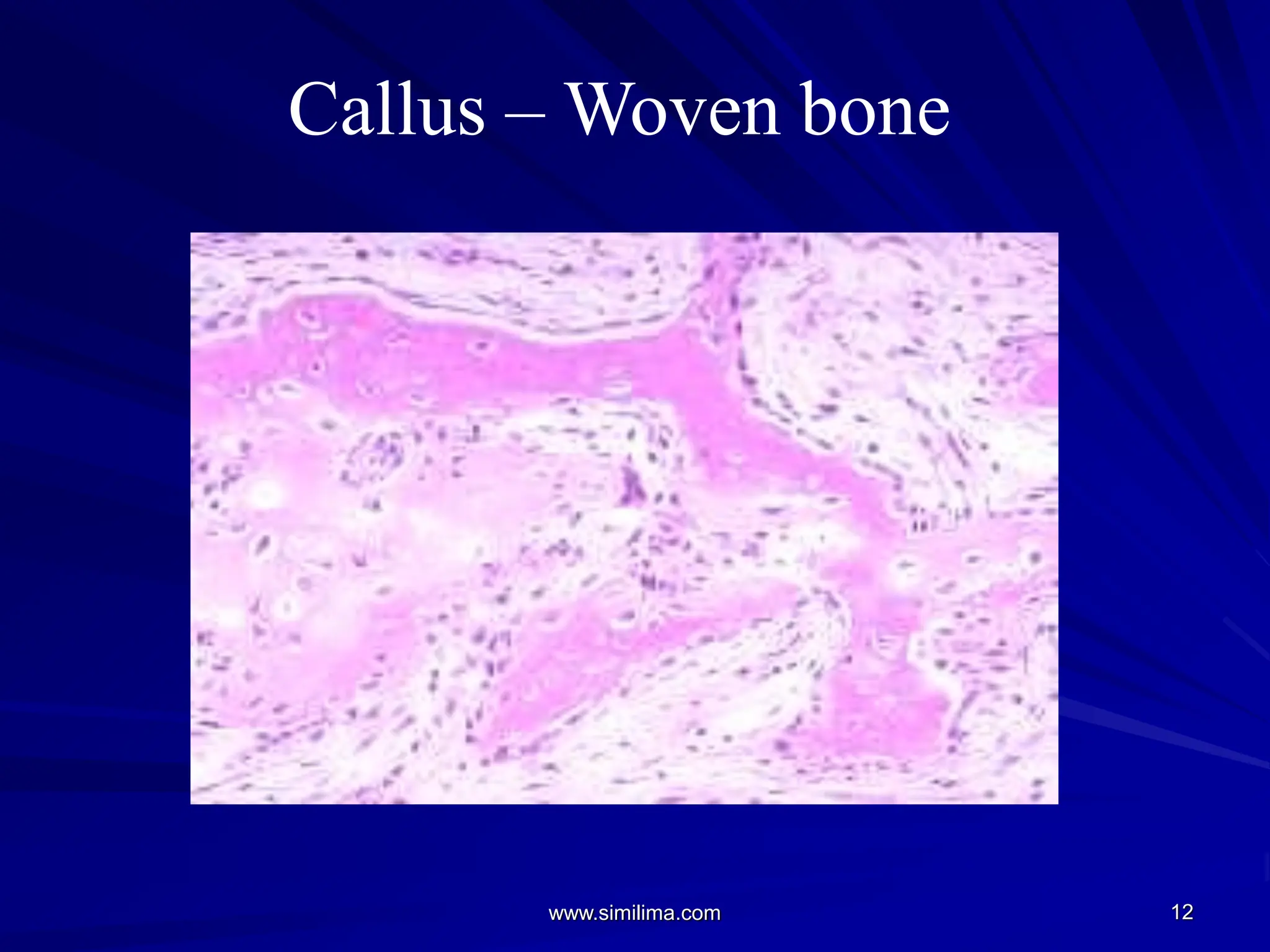 Healing of bone fracture- general pathology | PDF