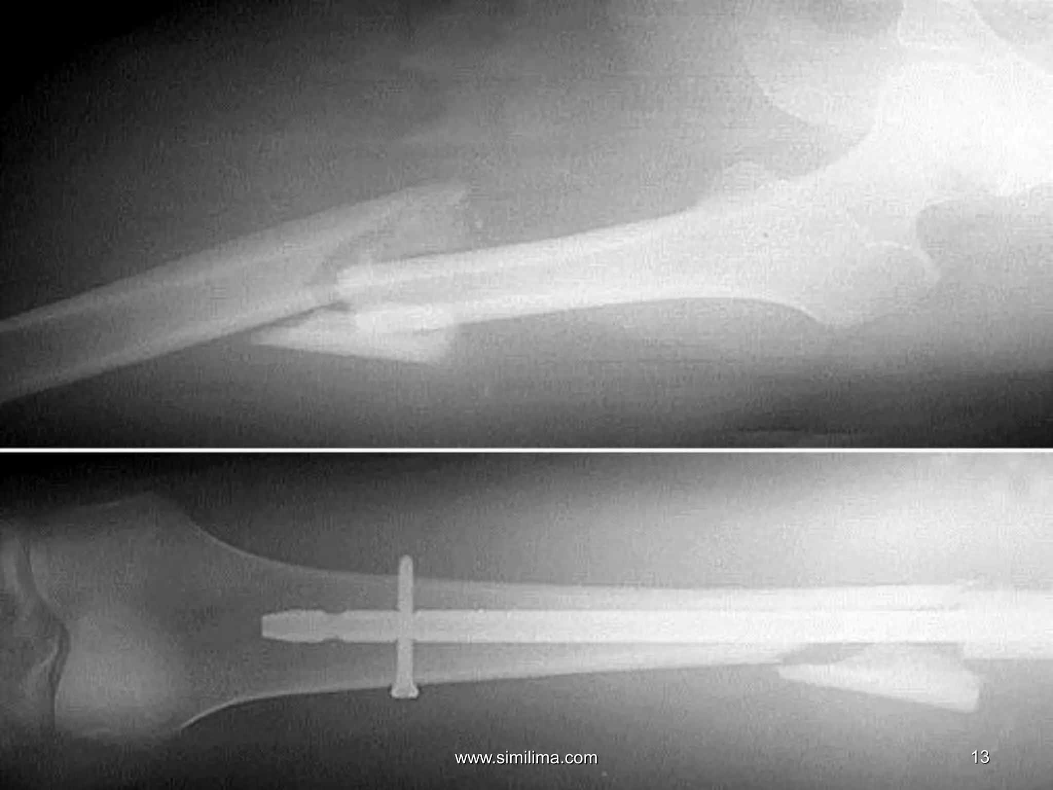 Healing of bone fracture- general pathology | PDF