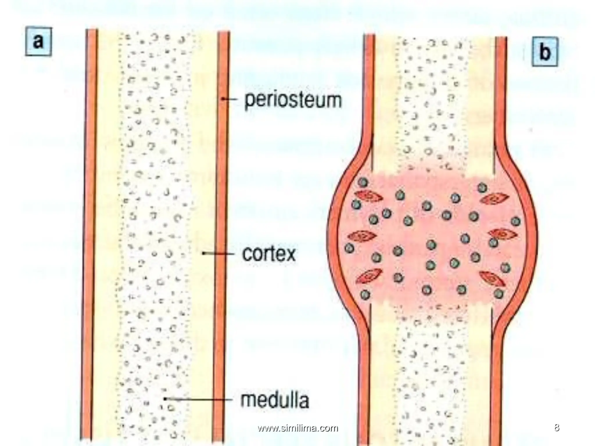 Healing of bone fracture- general pathology | PDF