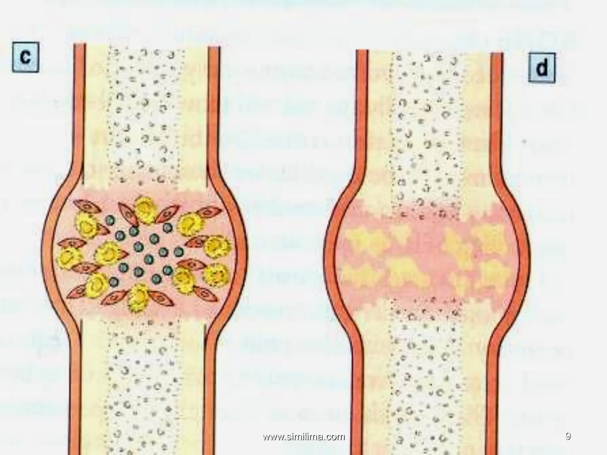 Healing of bone fracture- general pathology | PDF