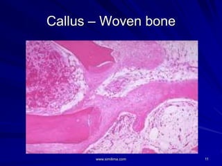 Healing of bone fracture- general pathology | PDF
