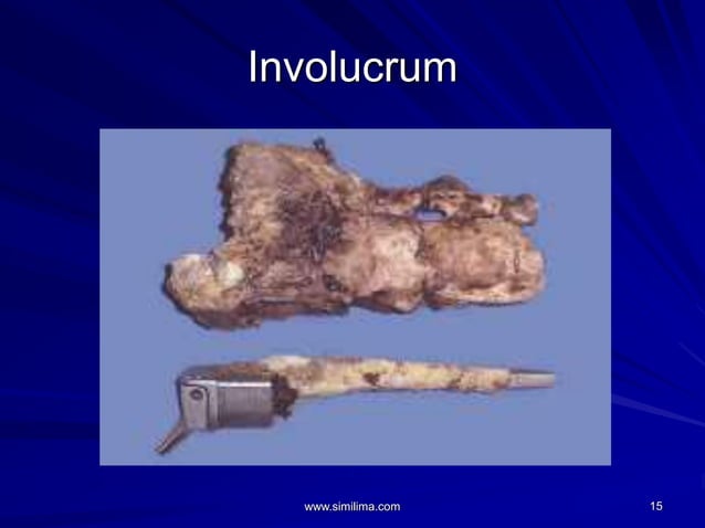 Healing of bone fracture- general pathology | PDF | Death, Injury, or ...