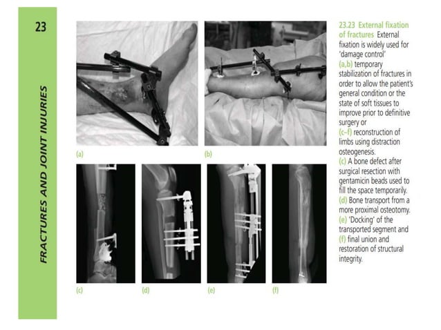 FRACTURE-MANAGEMENT.ppwer point presentation | PPT