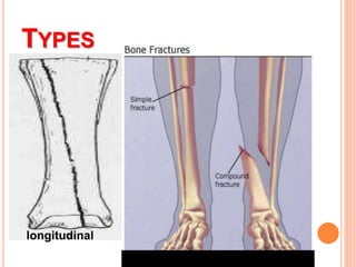 Fracture,types and its management-MSN... | PDF
