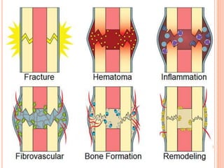Fracture,types and its management-MSN... | PDF