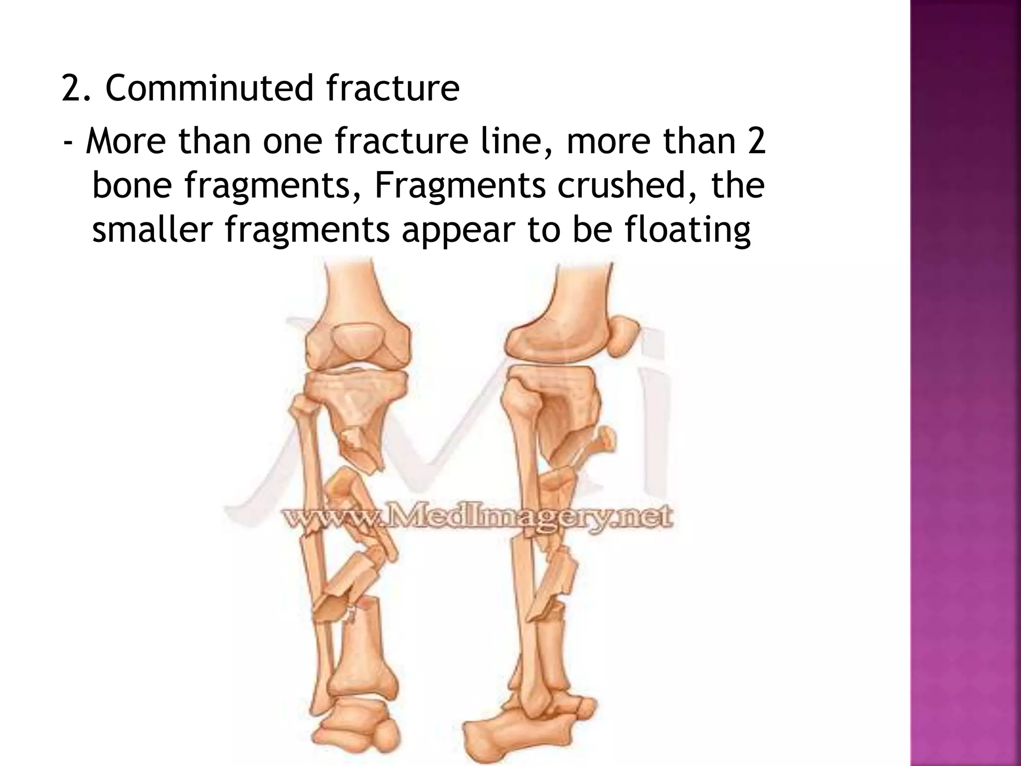 fracture-ppt.pptx