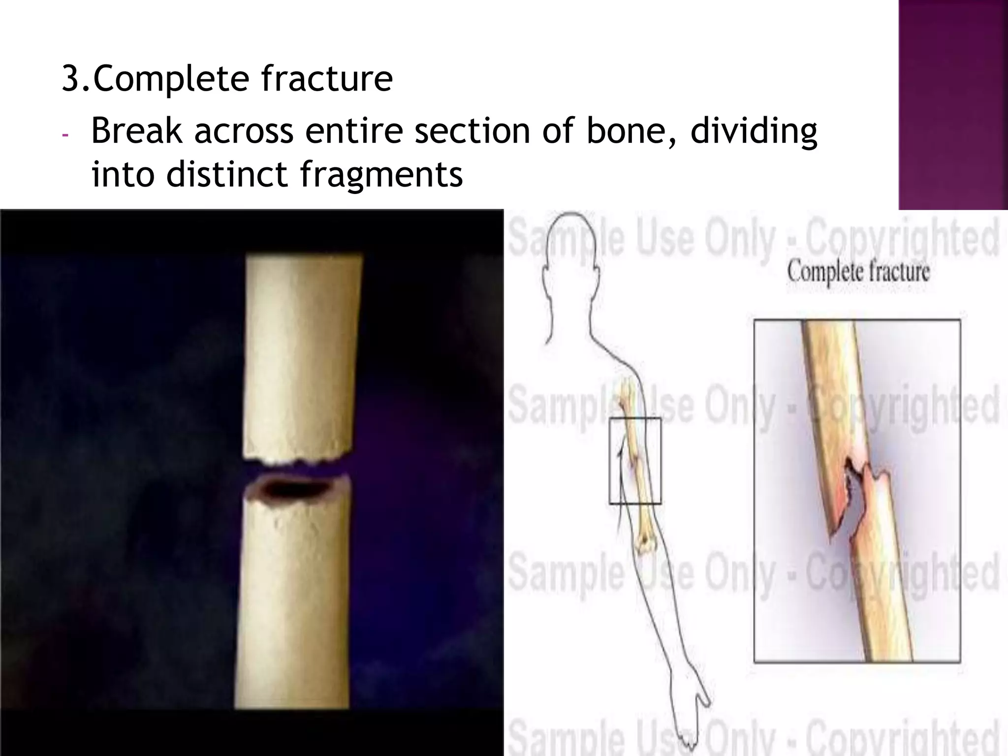 fracture-ppt.pptx | Death, Injury, or Military Conflict | Sensitive Topics