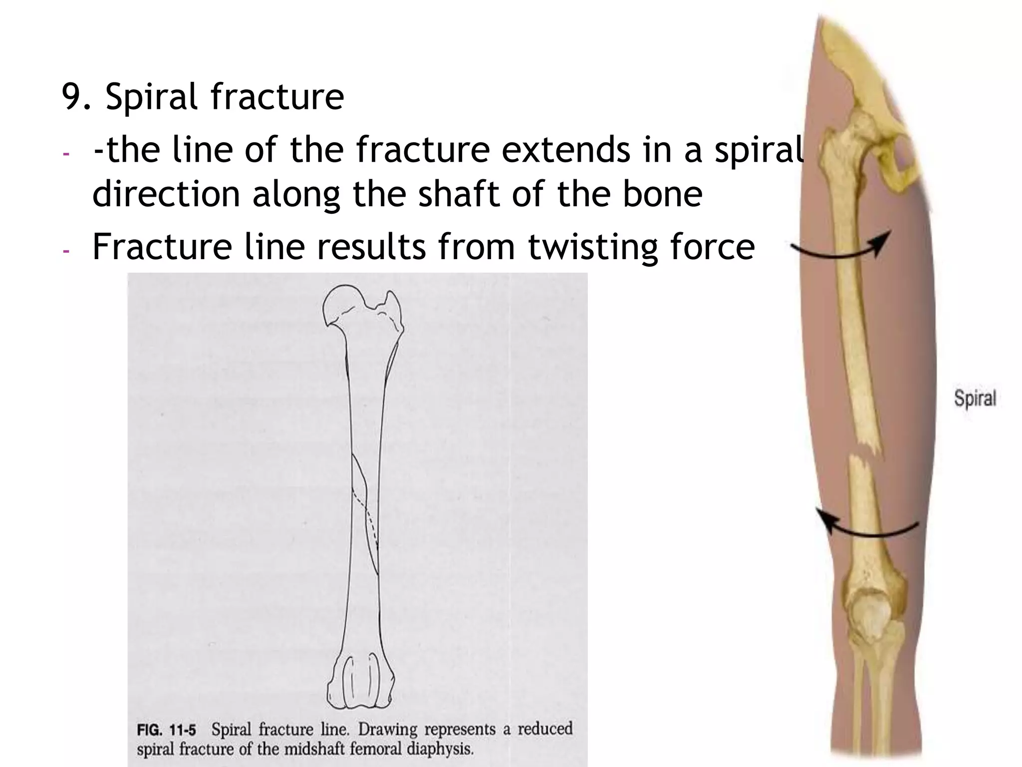 fracture-ppt.pptx