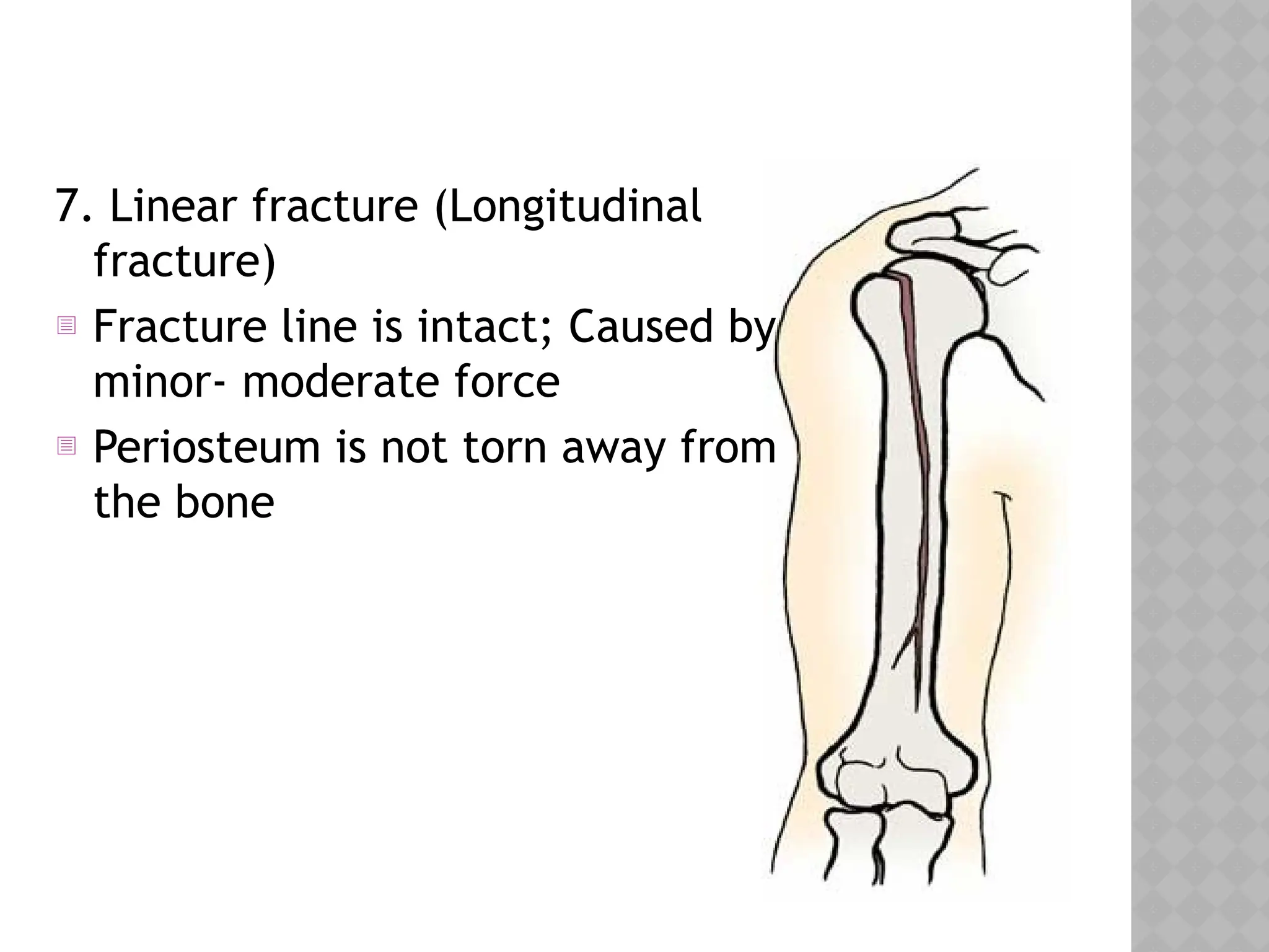 fracture-ppt.pptxdddddddddddddddddddddddddddddddcccccccc | PPTX