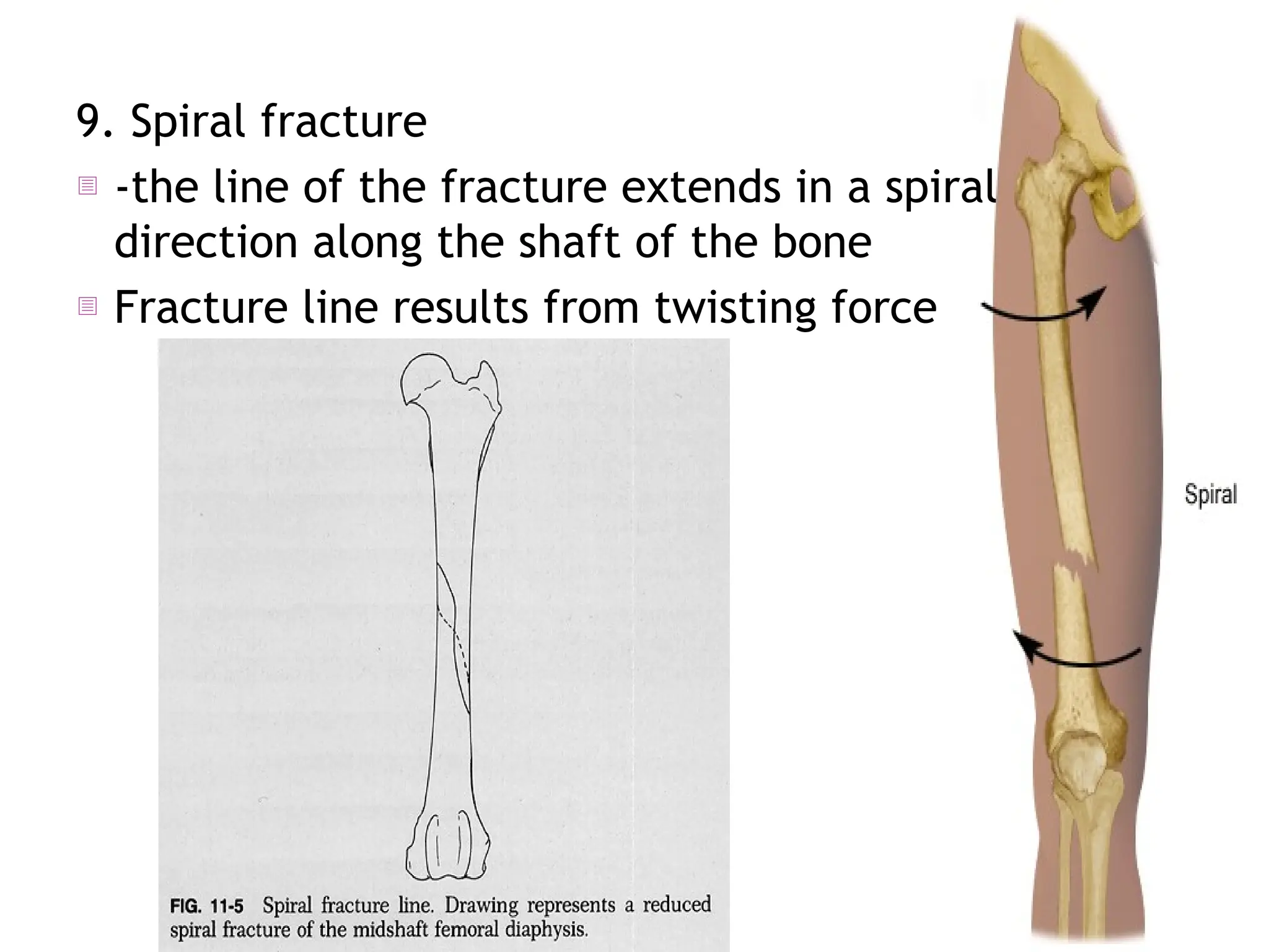 fracture-ppt.pptxdddddddddddddddddddddddddddddddcccccccc | PPTX
