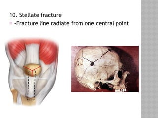 fracture-ppt.pptxdddddddddddddddddddddddddddddddcccccccc | PPTX