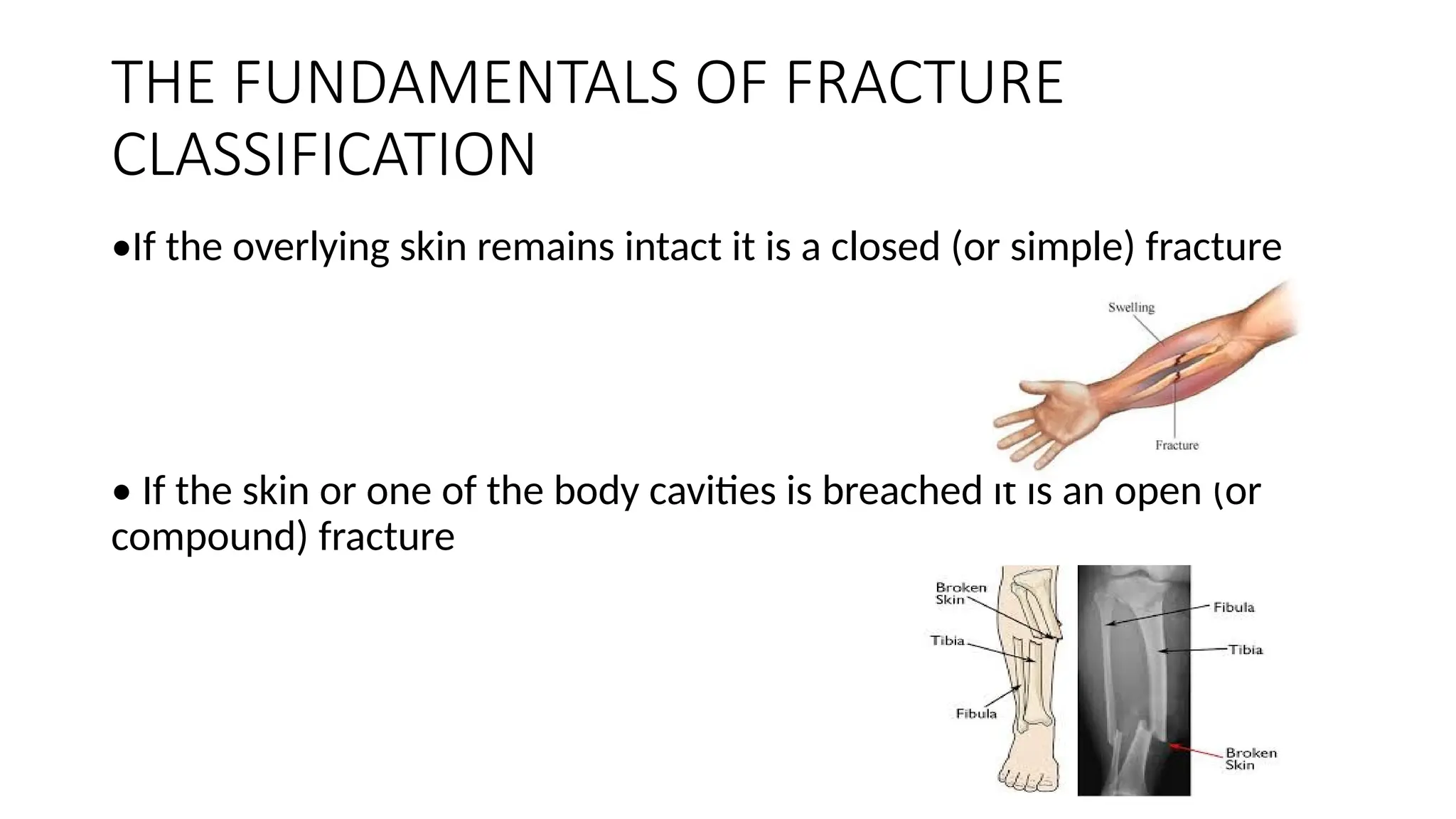 General principles of fracture management.pptx