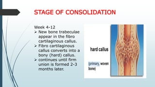 Fracture healing | PPTX