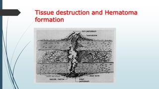 Fracture healing | PPTX