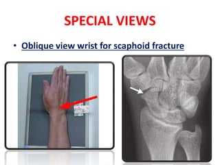 Fracture 3 | PPTX