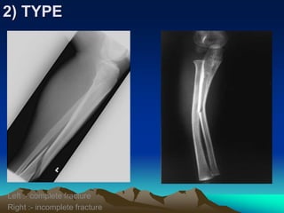 fracture and dislocation.ppt