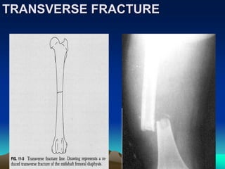 fracture and dislocation.ppt