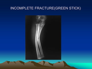 fracture and dislocation.ppt
