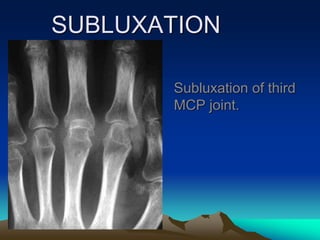fracture and dislocation.ppt