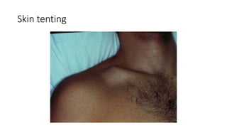 Fracture and dislocation of the shoulder girdle | PPTX