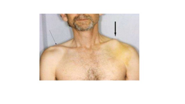 Fracture and dislocation of the shoulder girdle